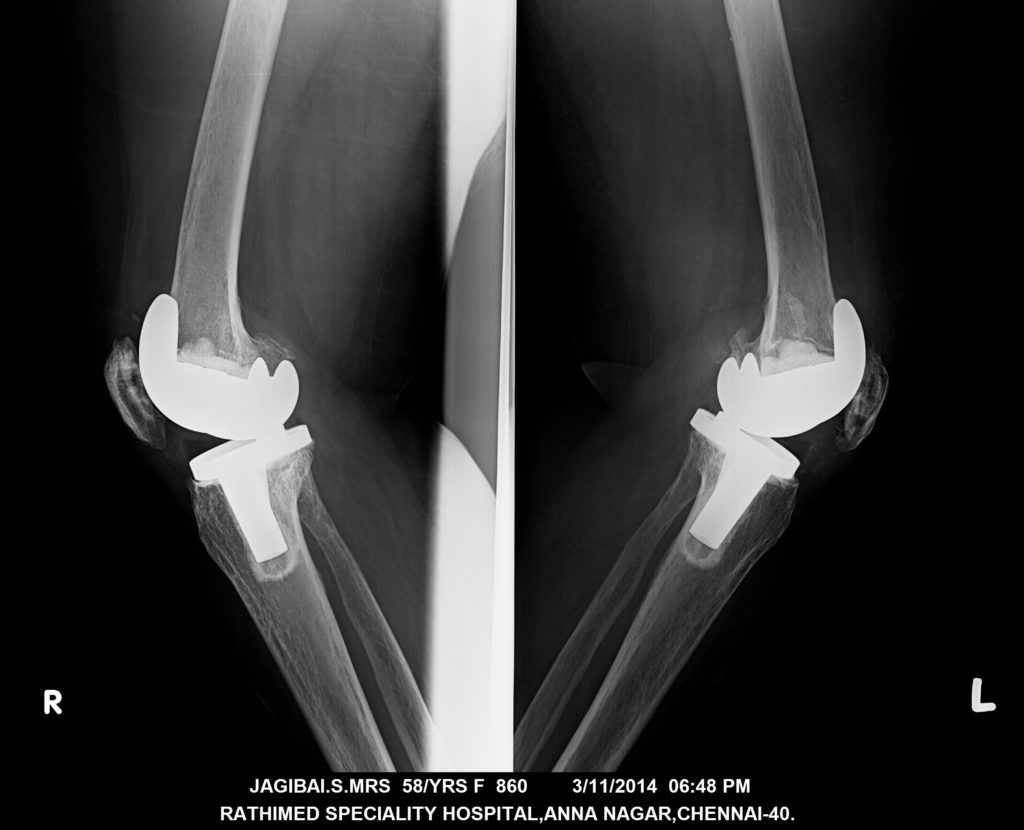 Total Knee Replacement Chennai | Knee Joint Surgery India